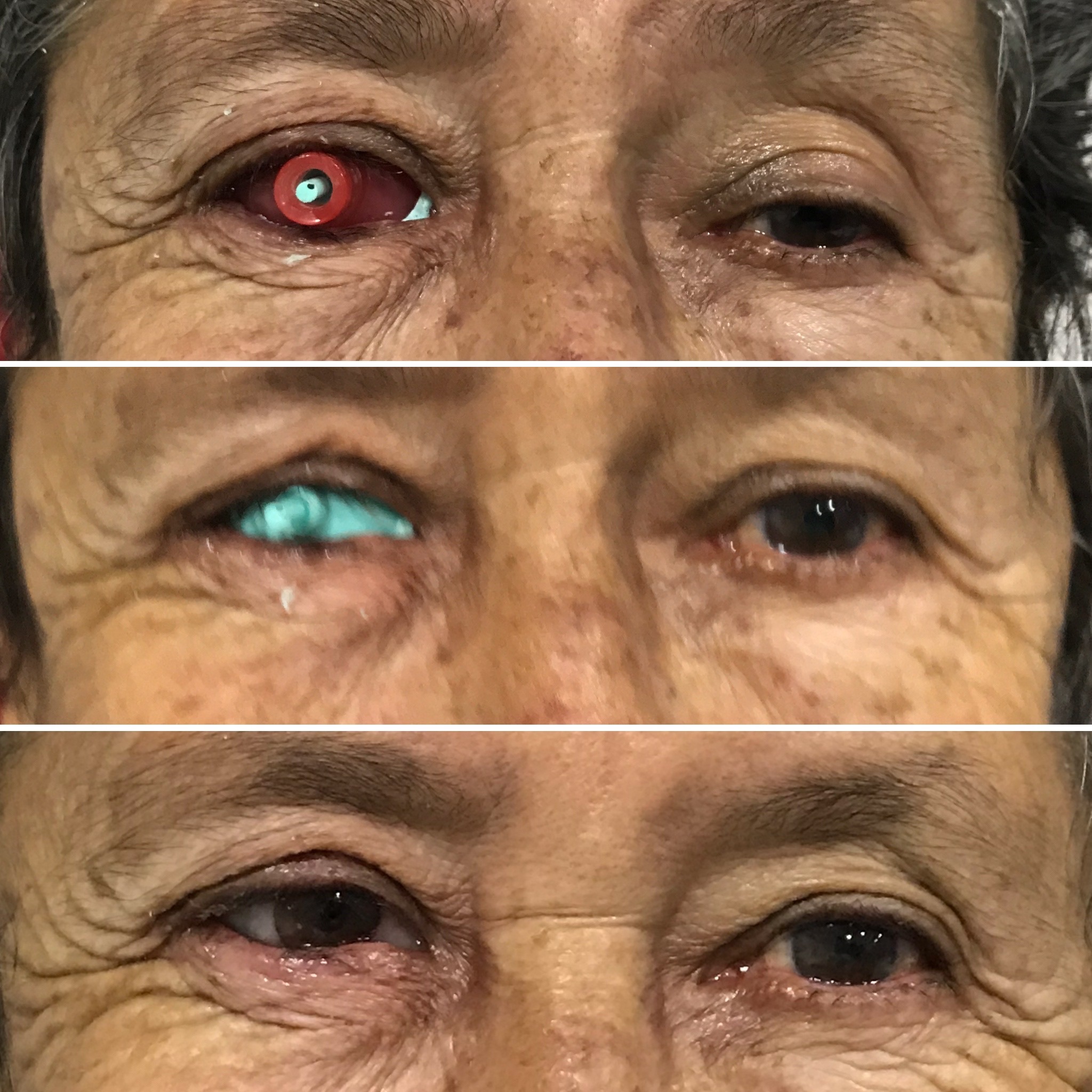 Protesis Personalizadas – Prótesis Oculares López